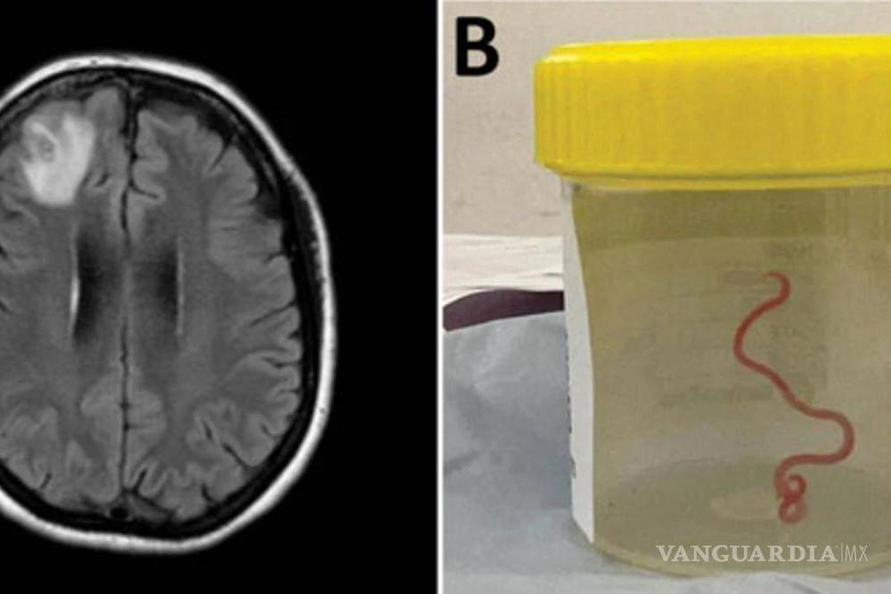 Descubren lombriz intestinal en el cerebro a una mujer en Australia