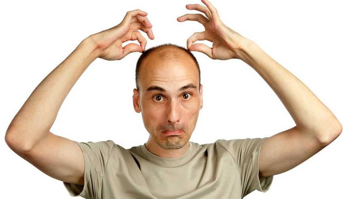 Cinco datos que deberías saber sobre la calvicie