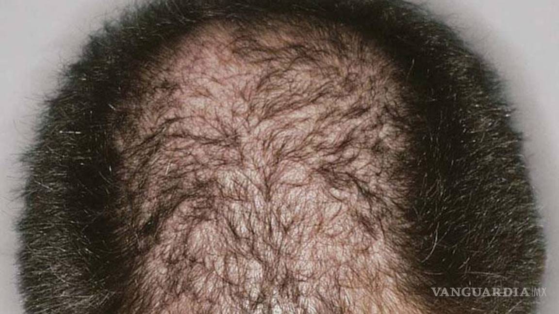 Desde los 27 años inicia la pesadilla de la calvicie
