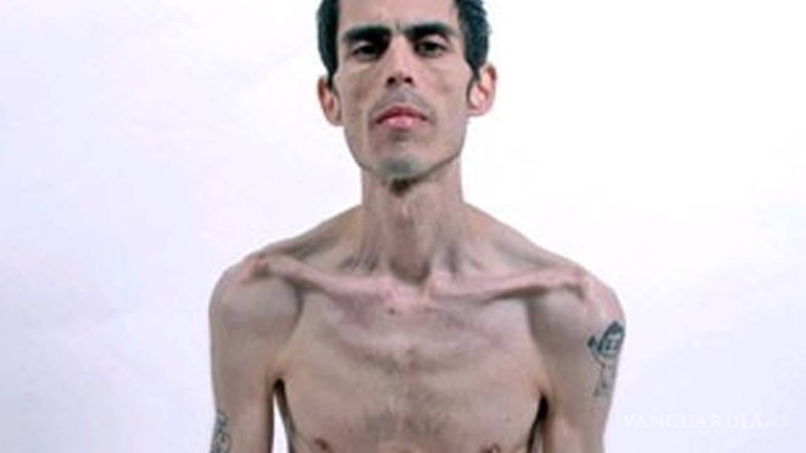 En México aumentan los casos de anorexia y bulimia en hombres