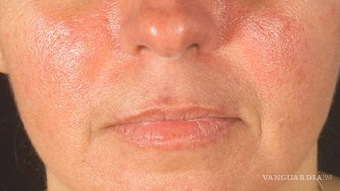 El 10 de Mayo también es el Día Mundial del Lupus