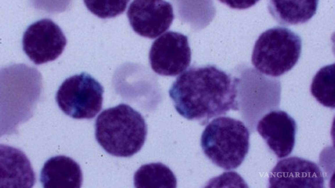 Detectan genes implicados en leucemia linfática