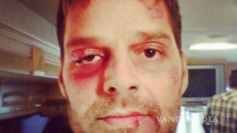 Ricky Martin y una impactante foto en Twitter con su rostro golpeado