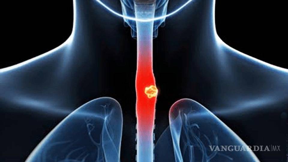 7 señales del cáncer de esófago